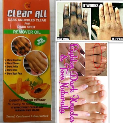 Clear Dark Spot Clear All Dark Knuckles Clear And Dark Spot Remover ...